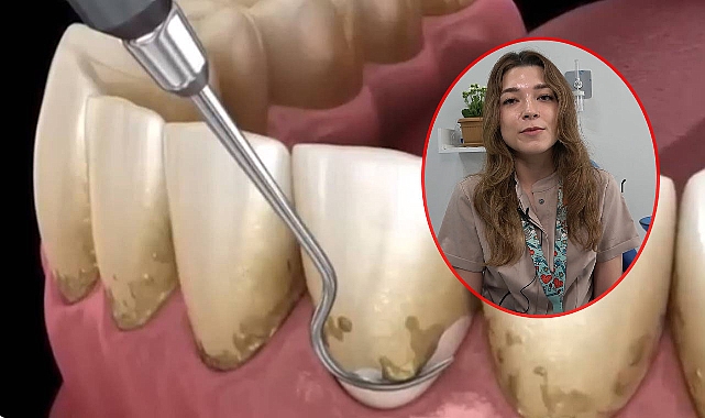 Uzmanı açıkladı! Diş taşı nedir, nasıl tedavi edilir? - Sağlık - Ajans ...